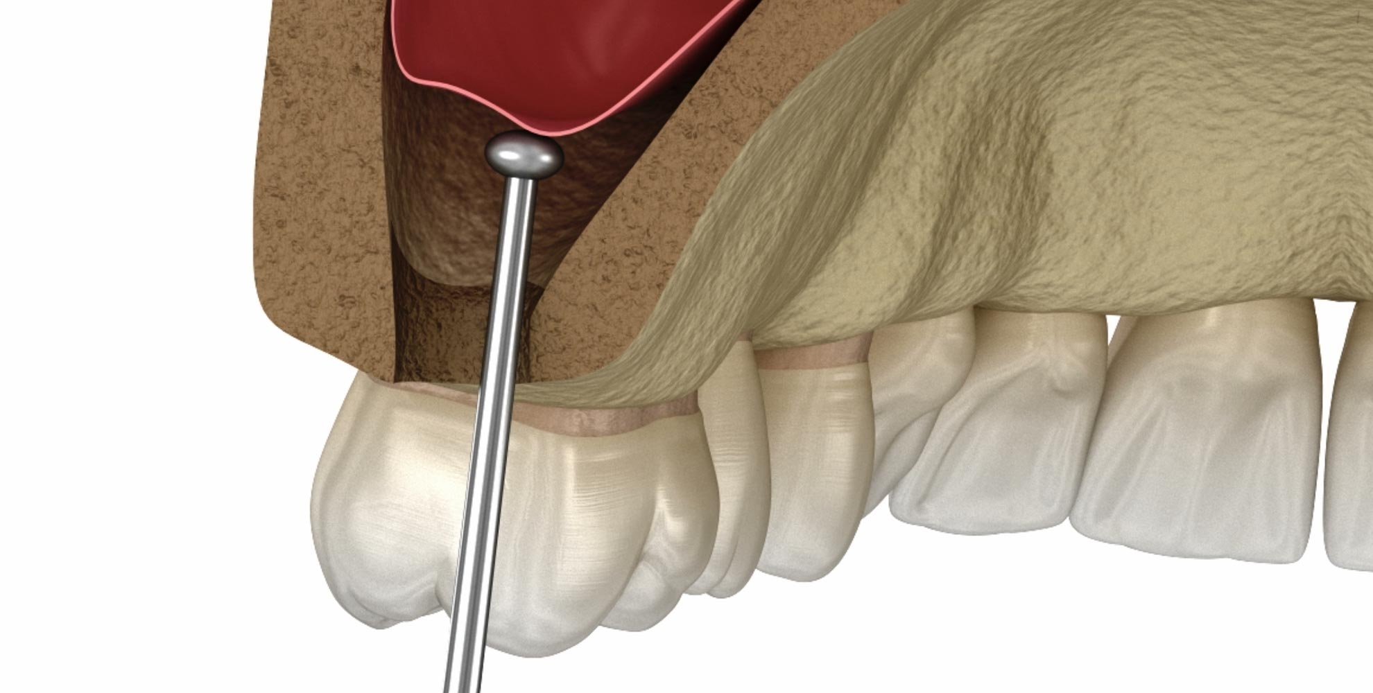 Sinus Lifting for Enhanced Implant Success | Opus Smile