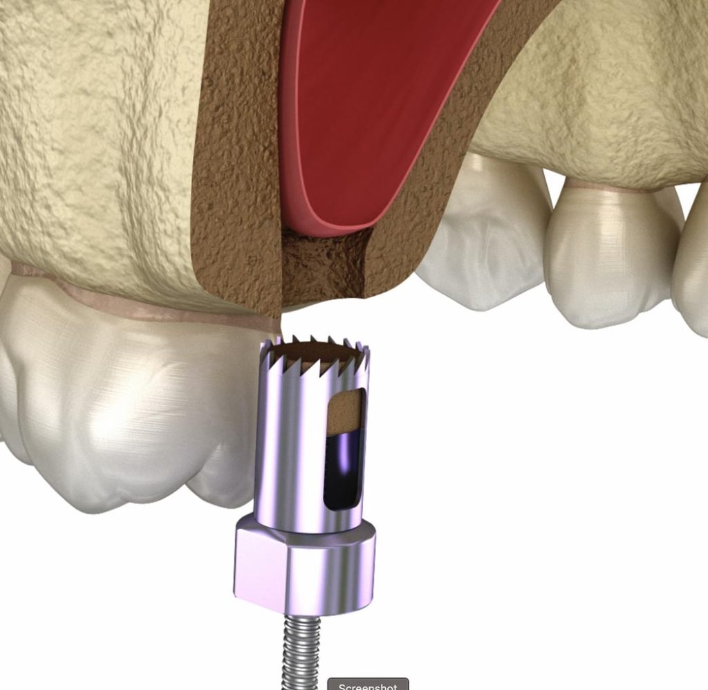 Sinus Lifting for Enhanced Implant Success | Opus Smile