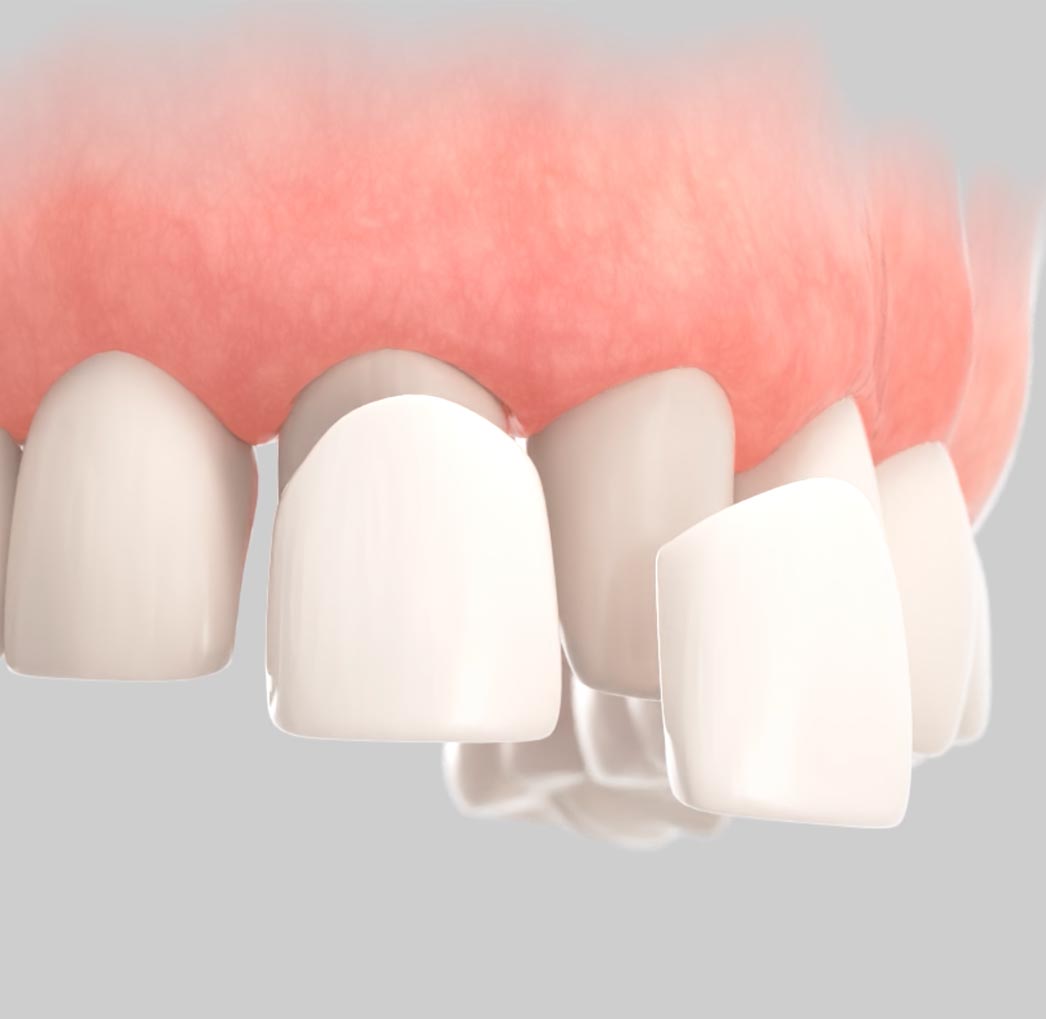 Veneers: Your Pathway to a Dazzling Smile | Opus Smile