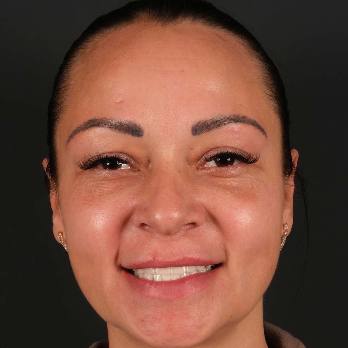 Smile Transformations: Before & After Case Studies | Opus Smile