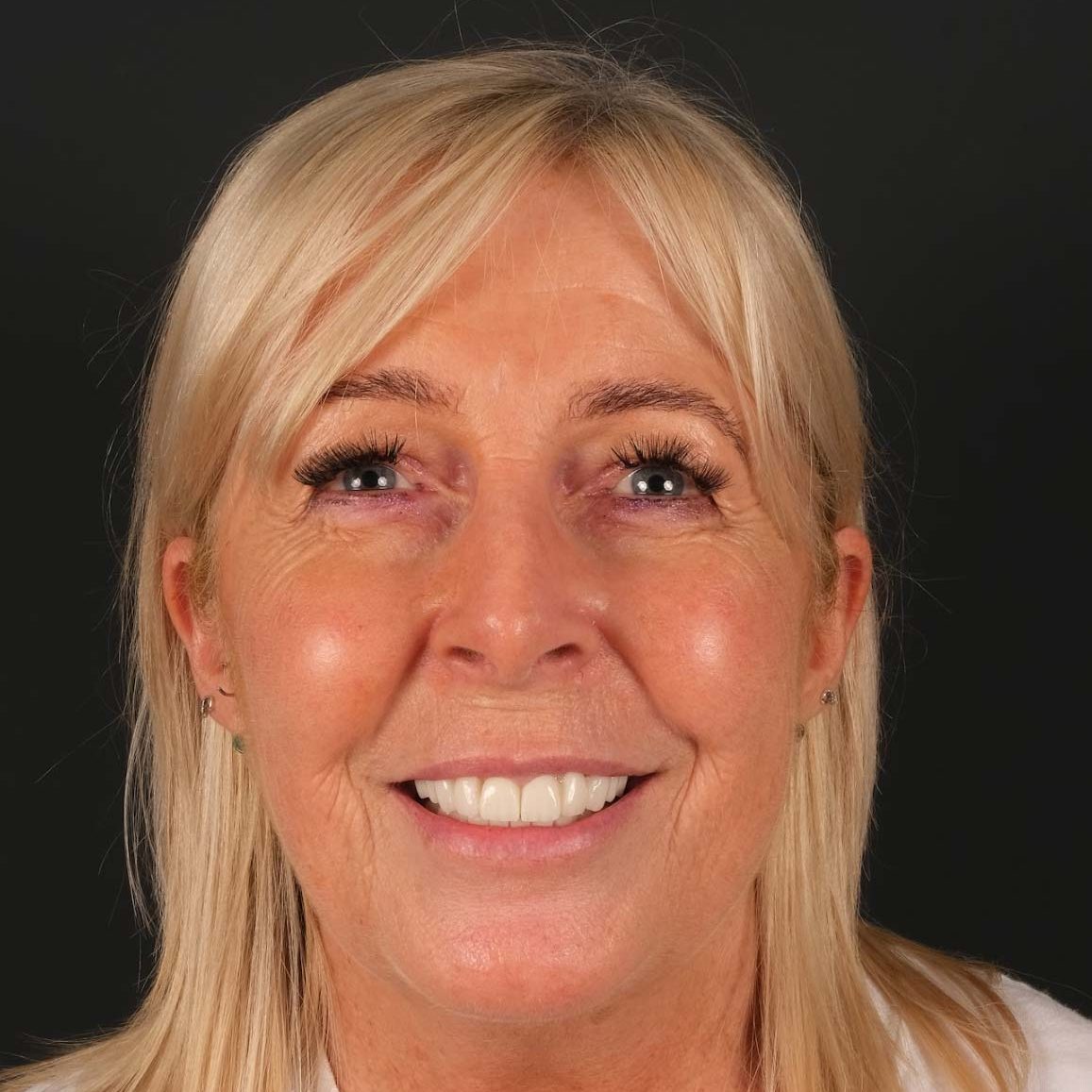 Smile Transformations: Before & After Case Studies | Opus Smile
